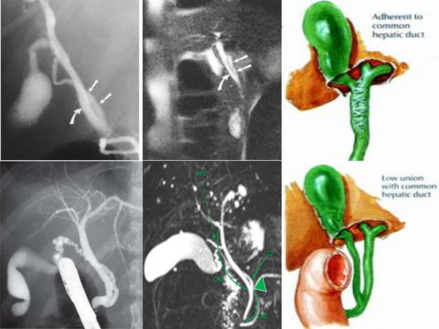Gall bladder & biliary tract anomalies and variants | PPTX | Pregnancy ...