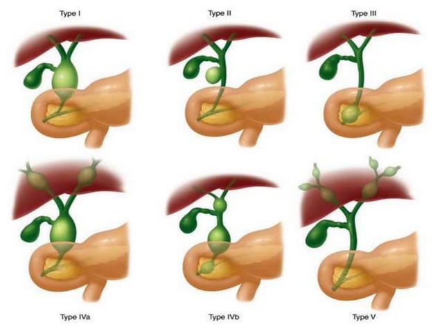 Gall bladder & biliary tract anomalies and variants
