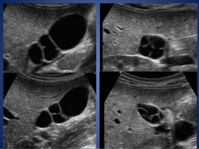 Gall bladder & biliary tract anomalies and variants