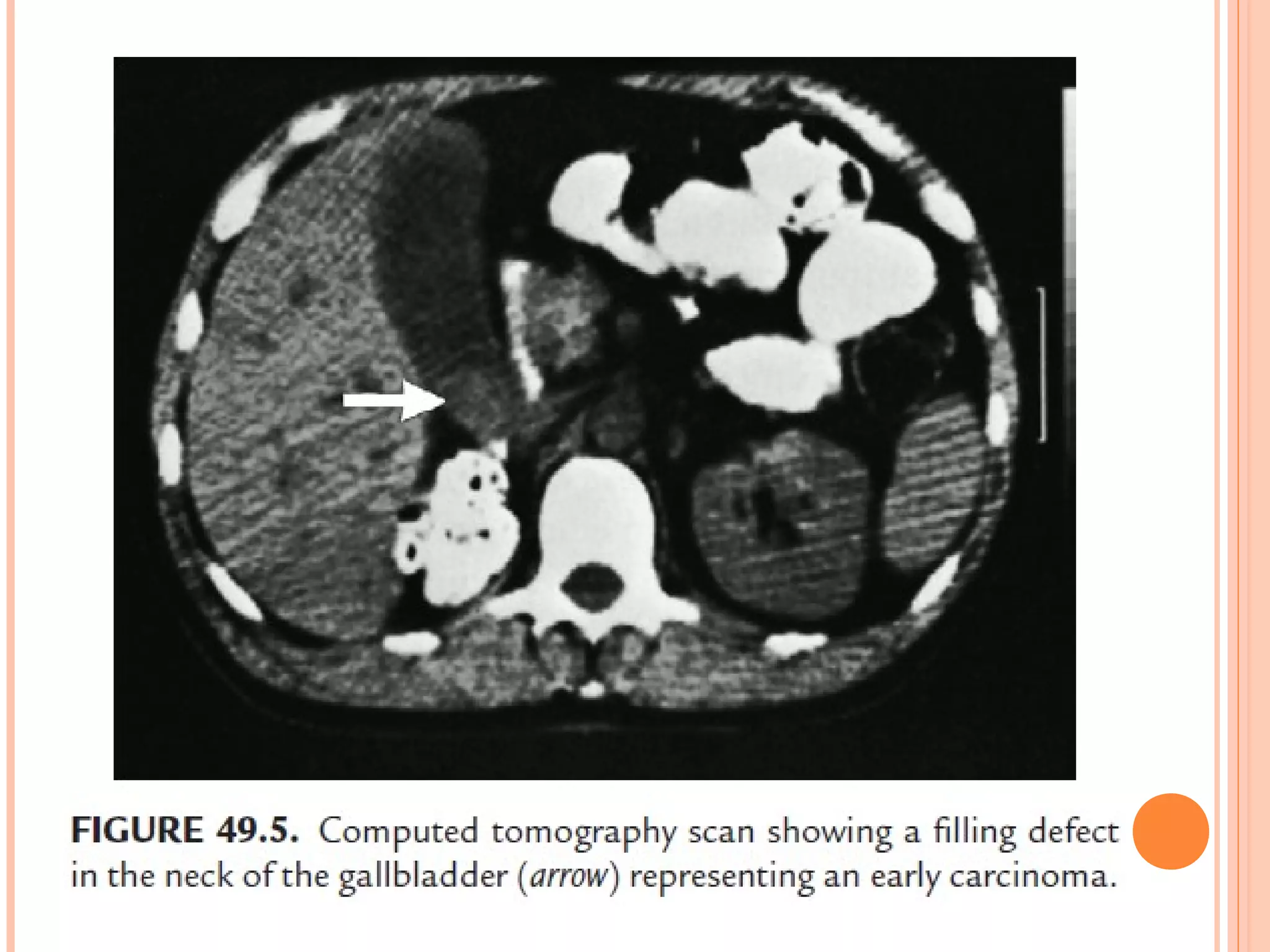 Gall bladder cancer | PPT