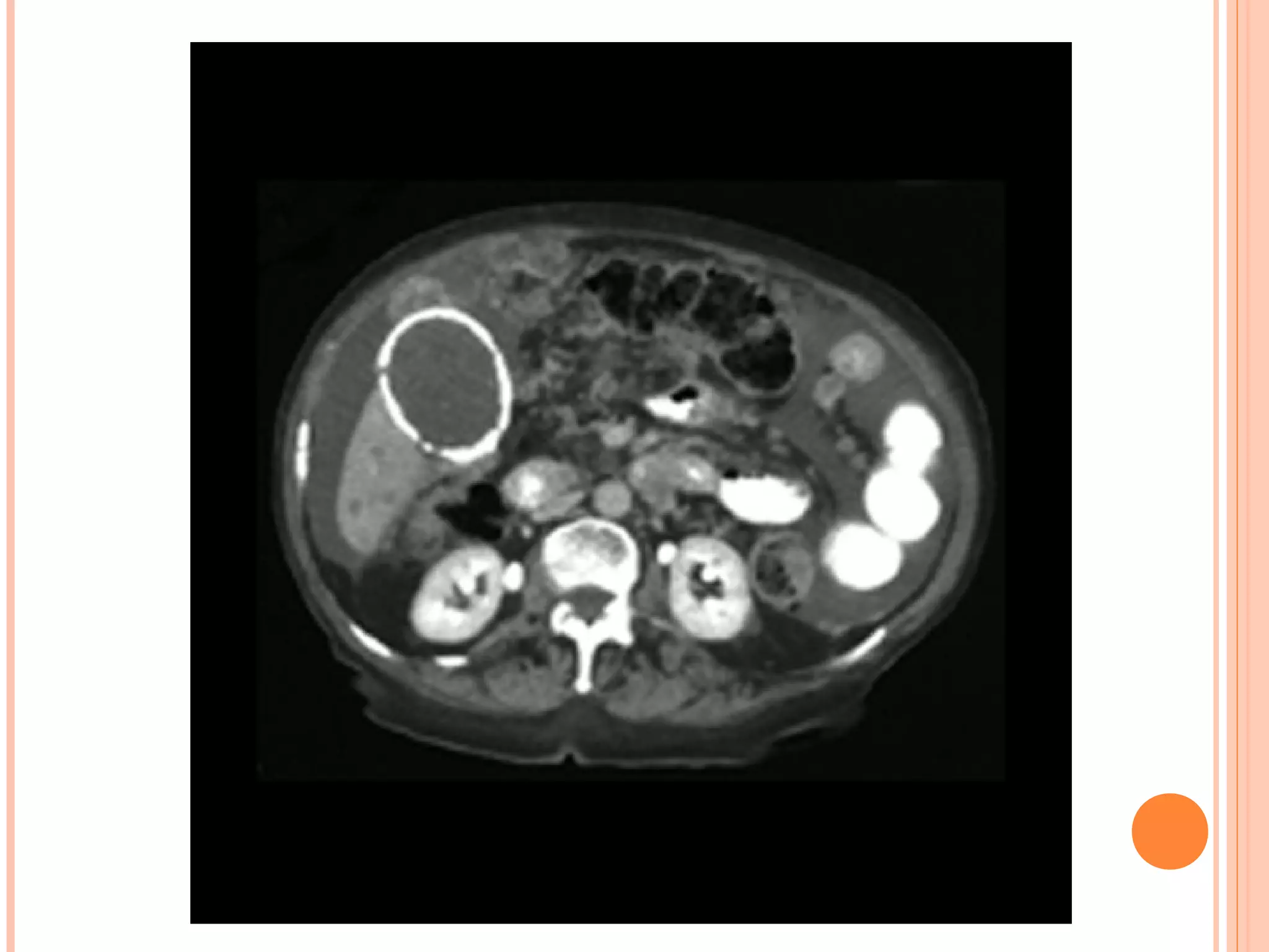 Gall bladder cancer | PPT