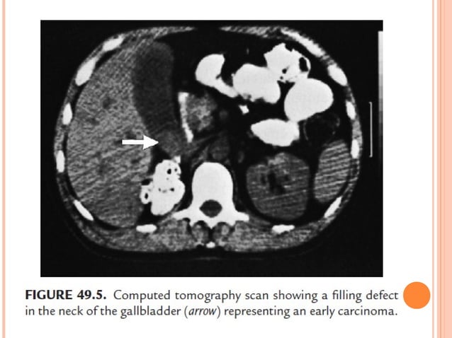 Gall bladder cancer | PPT