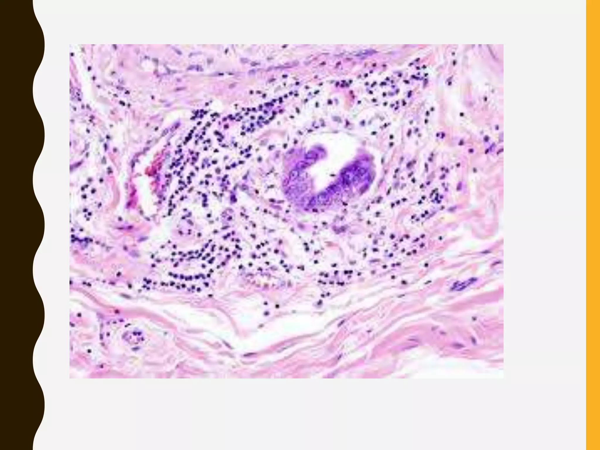 Gall bladder cancer | PPTX