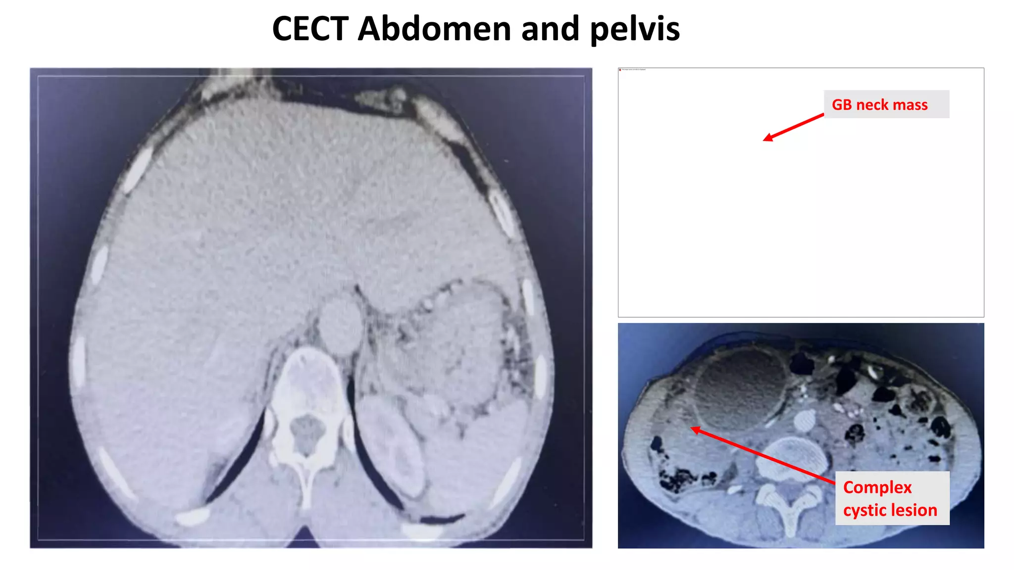 Gall Bladder Cancer.pptx