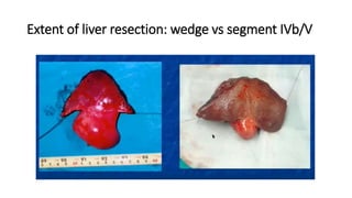 Gall Bladder Cancer.pptx