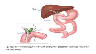 Gall Bladder Cancer.pptx