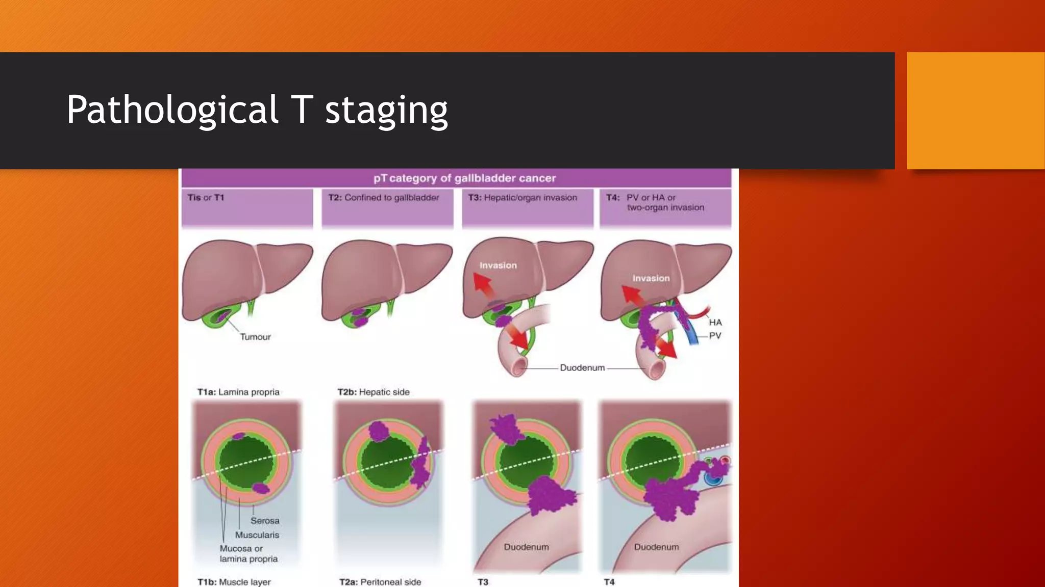 A complete gallbladder cancer review.pptx
