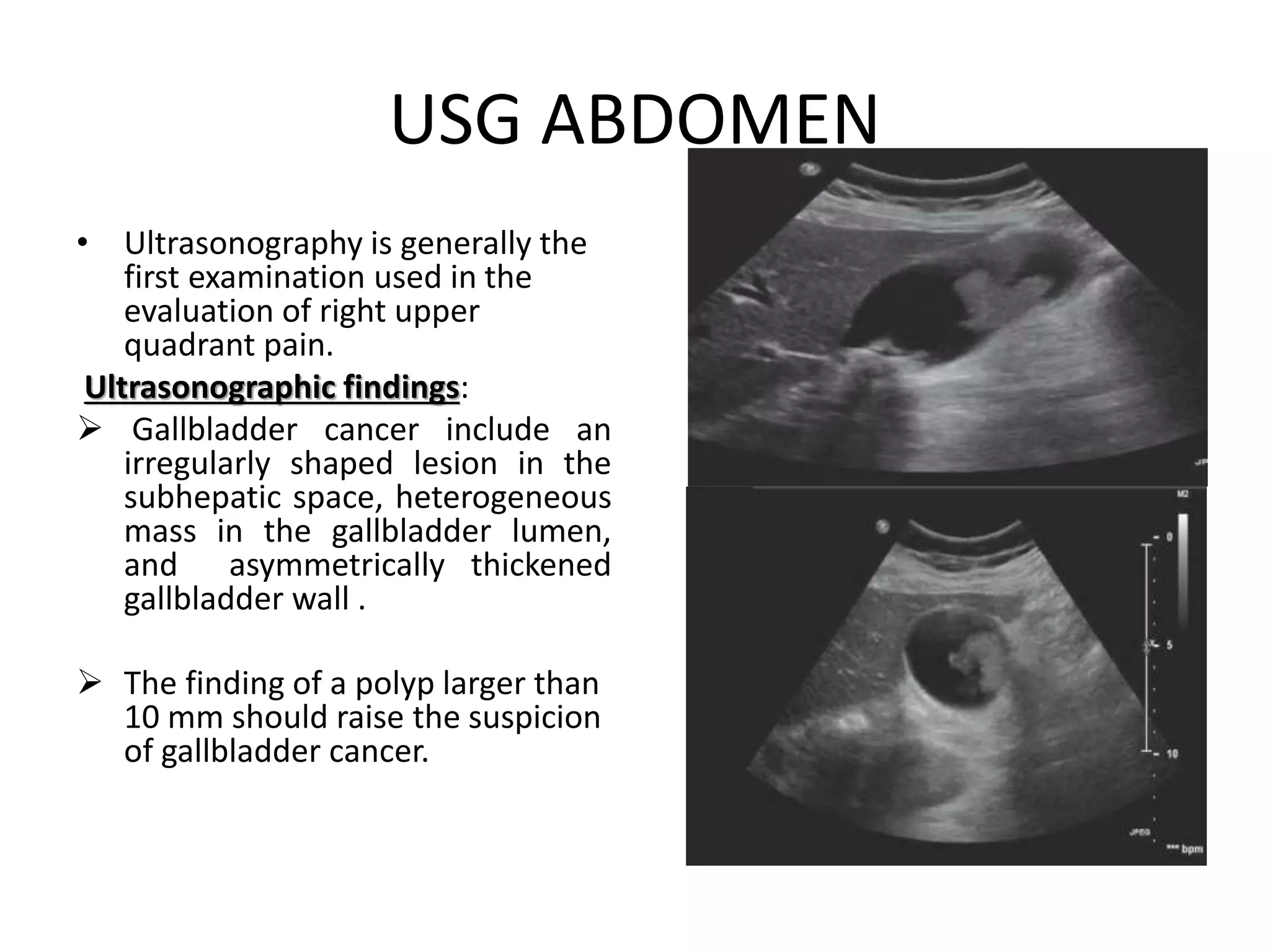 GALLBLADDER CANCER.pptx