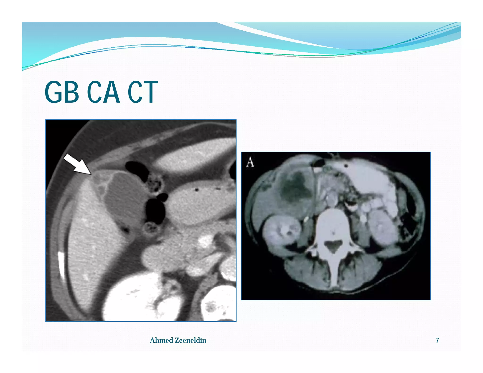 Gall bladder carcinoma | PDF