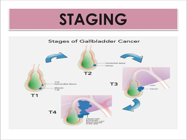 Gall bladder carcinoma.03