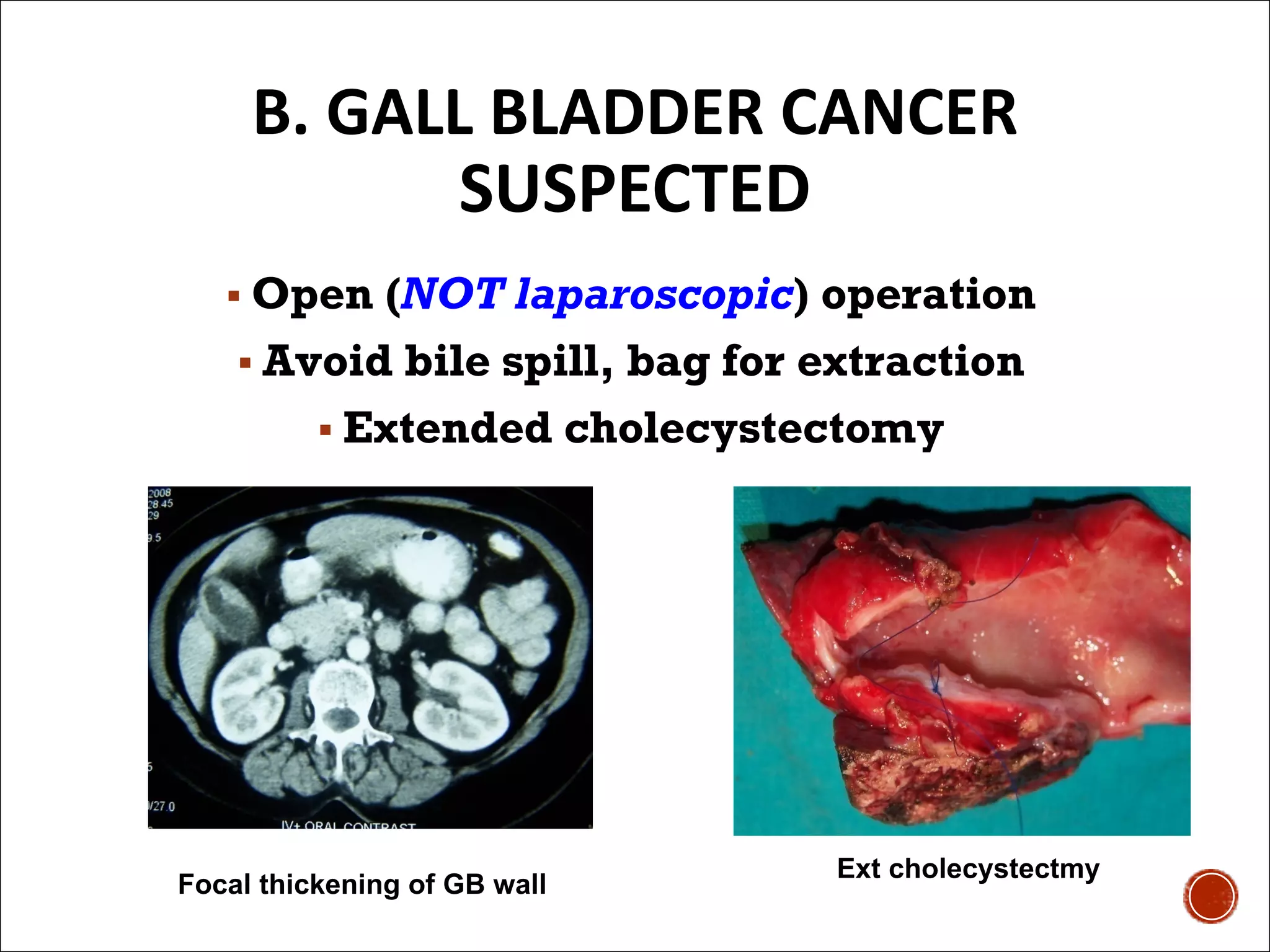 Gall bladder carcinoma.04