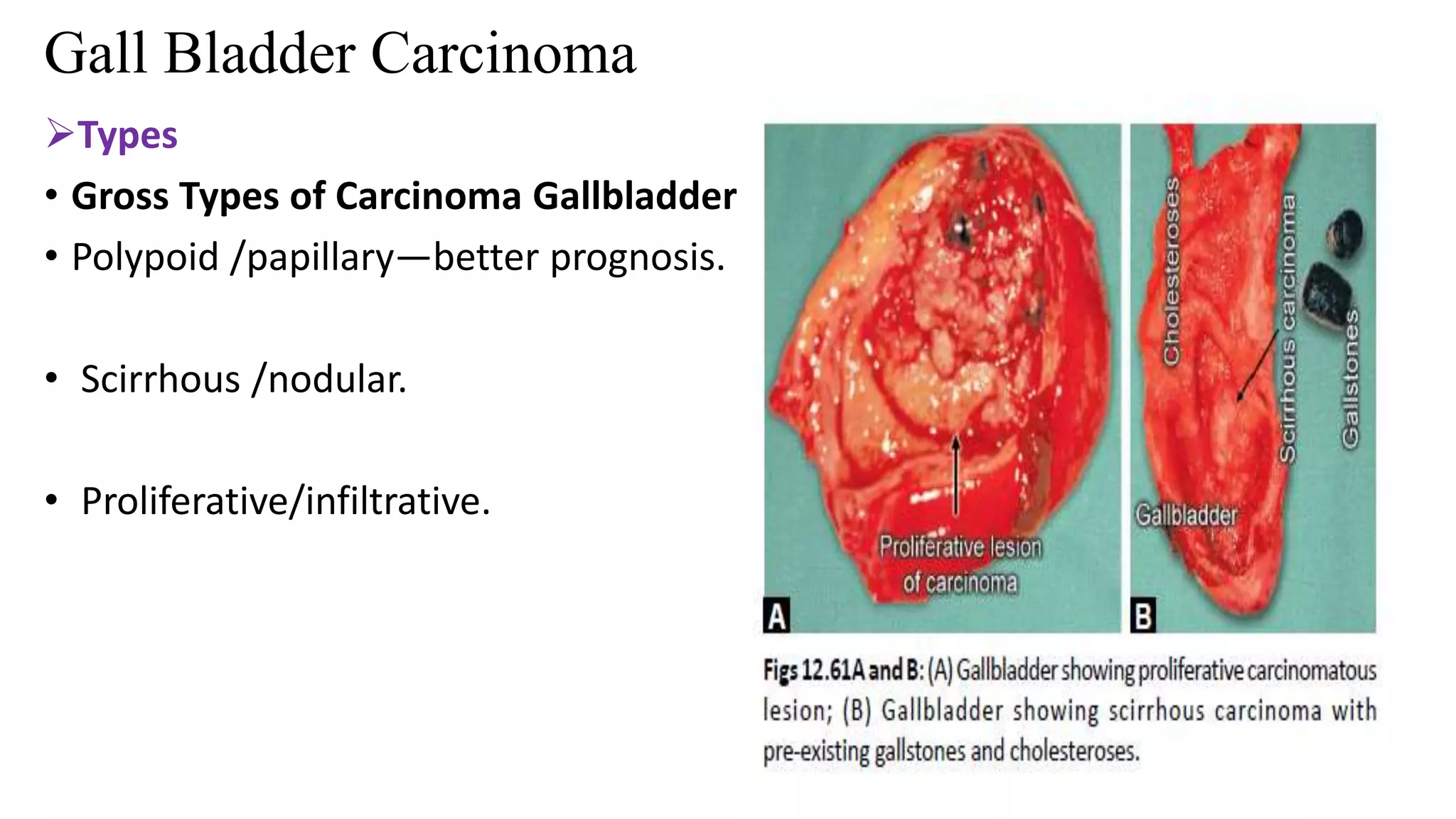 Gall bladder carcinoma | PPTX