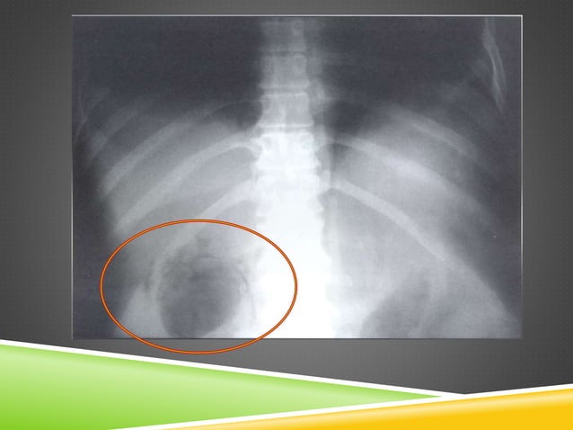 Gallbladder disease galster | PPT