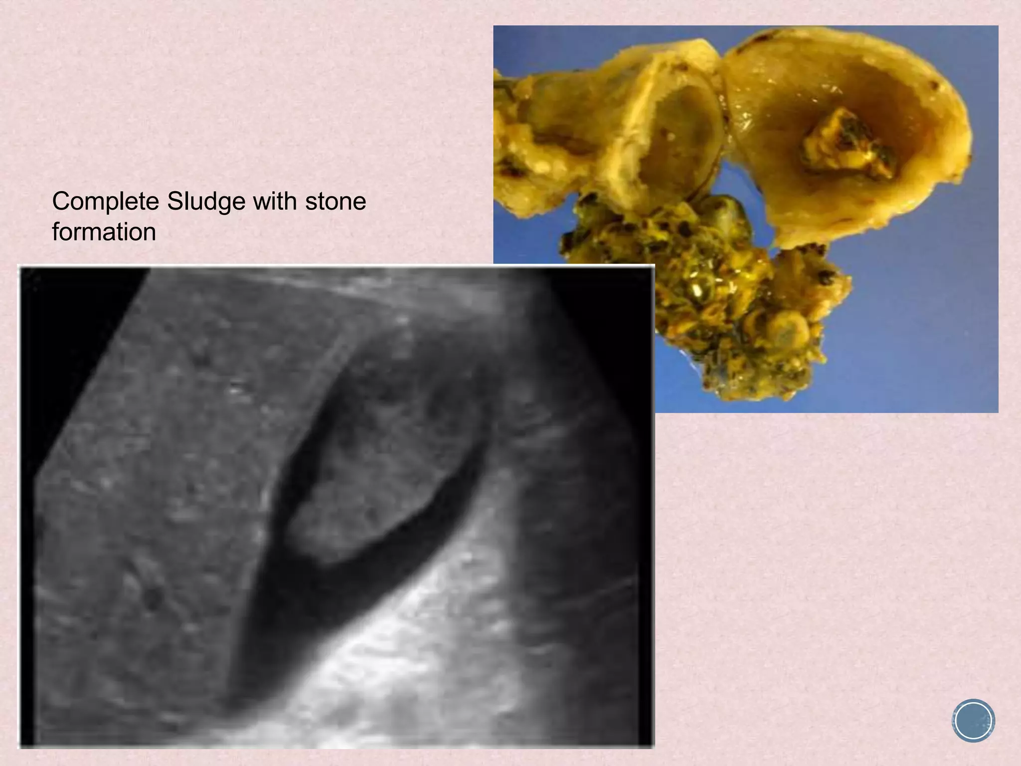 Gallbladder Disease in Children.pptx