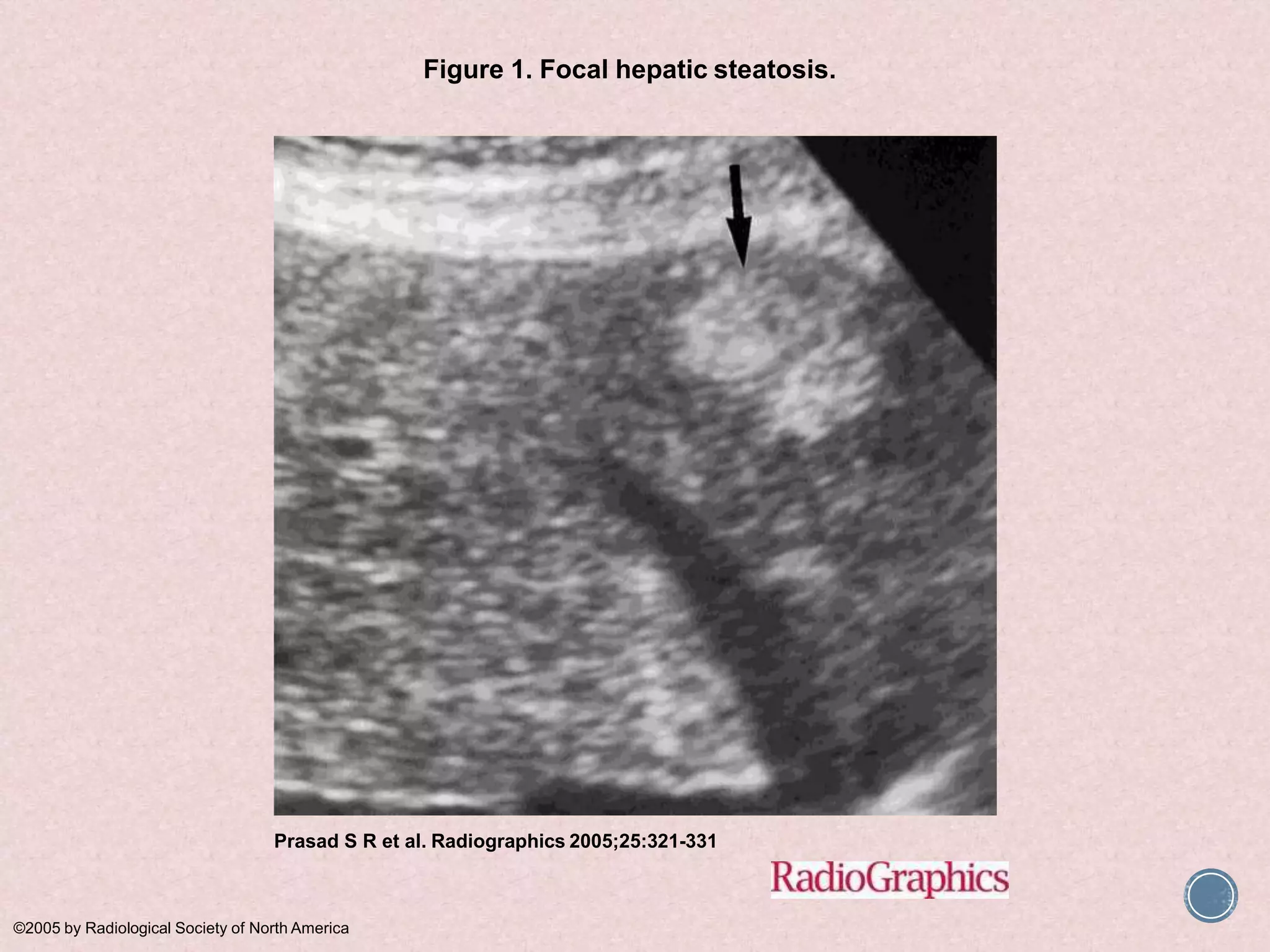 Gallbladder Disease in Children.pptx