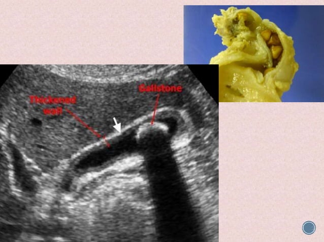 Gallbladder Disease in Children.pptx