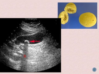 Gallbladder Disease in Children.pptx