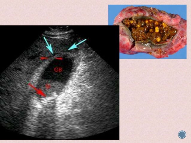 Gallbladder Disease in Children.pptx