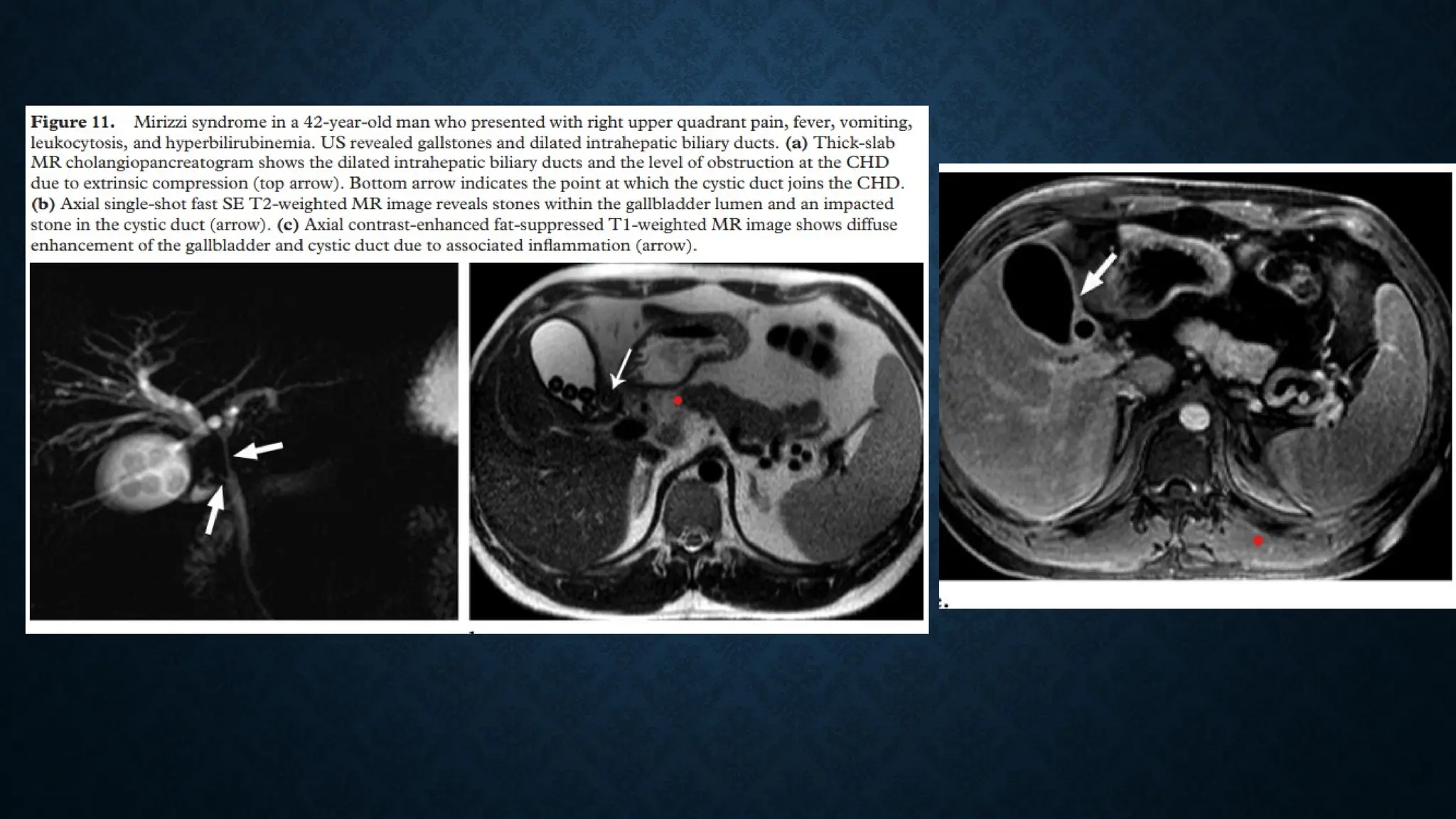 imaging works n gall bladder pathologies | PPTX