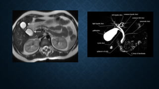 imaging works n gall bladder pathologies | PPTX