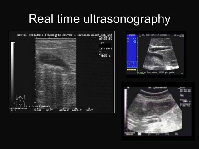 Gallbladder & extrahepatic biliary tree | PPTX | Pregnancy ...