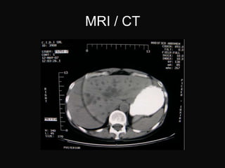 Gallbladder & extrahepatic biliary tree | PPTX