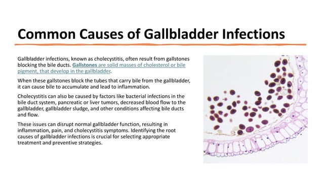 Gallbladder Infection - Exploring Treatment Options.pdf