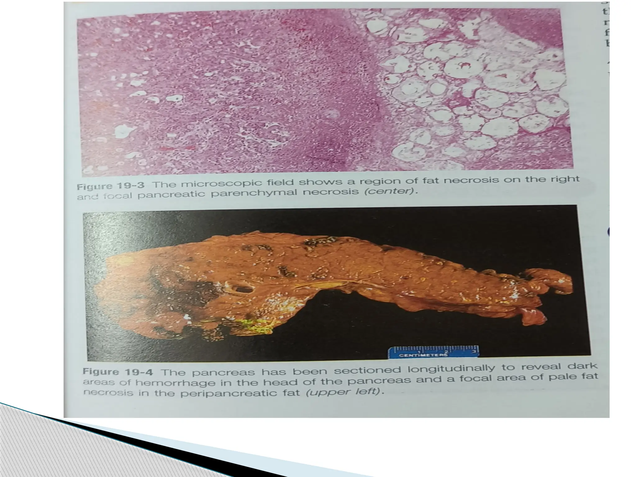 GALL BLADDER & PANCREAS pathology and diseases | PPTX