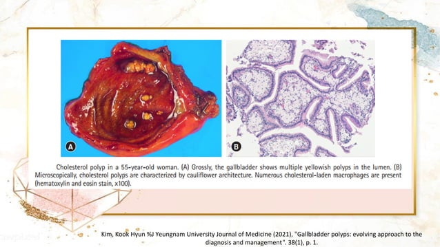 GALLBLADDER POLYPS (điều trị polyp túi mật).pdf