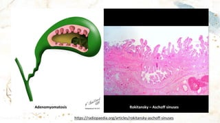 GALLBLADDER POLYPS (điều trị polyp túi mật).pdf
