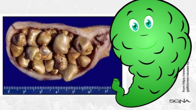 Fun Functional Gallbladder Disorders: Update on Hypo and Hyperkinetic ...