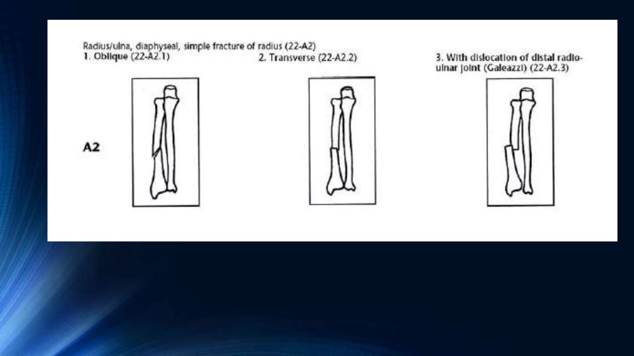 Galleazi fracture dislocation | PPTX