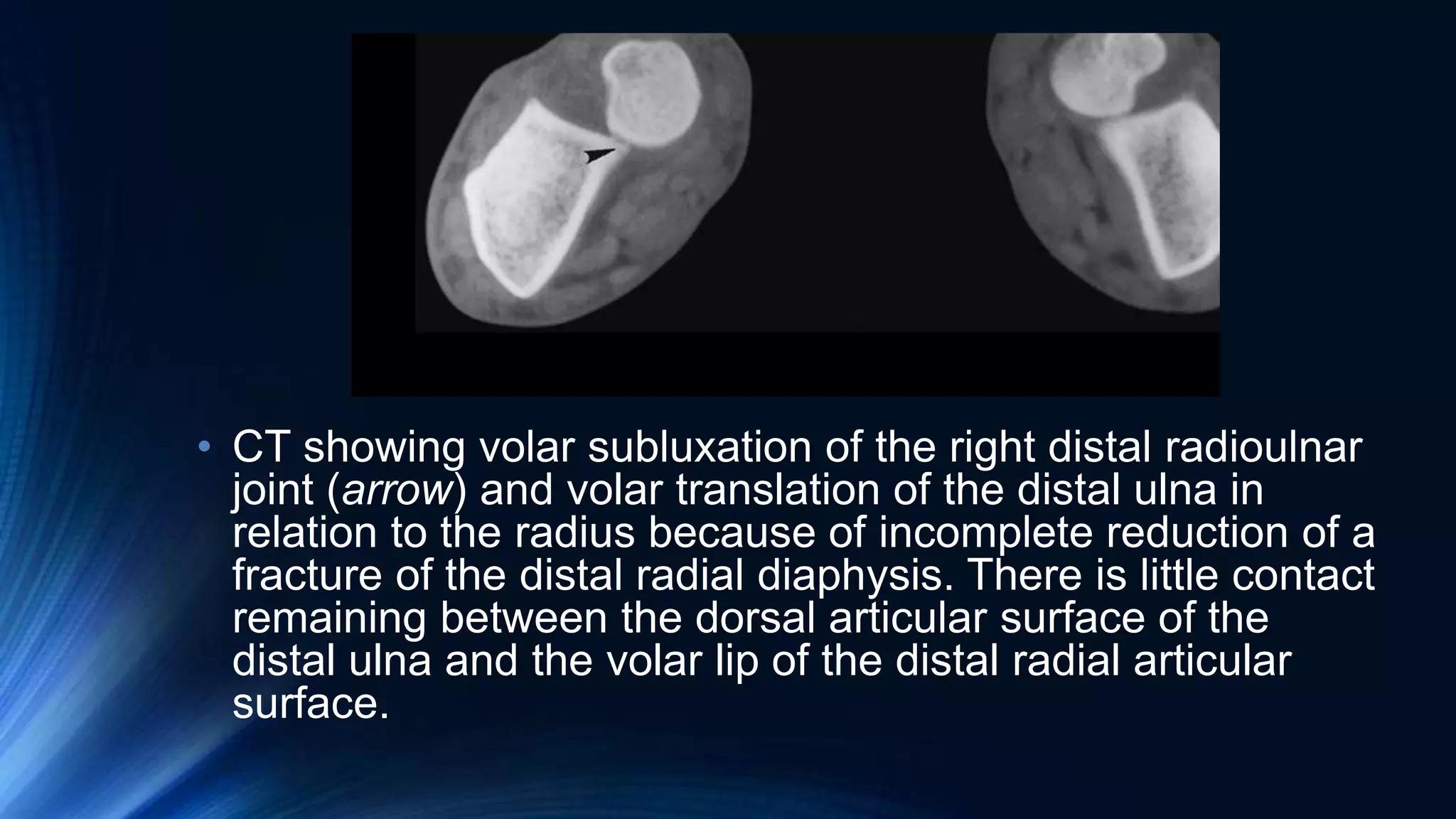 Galleazi fracture dislocation | PPTX