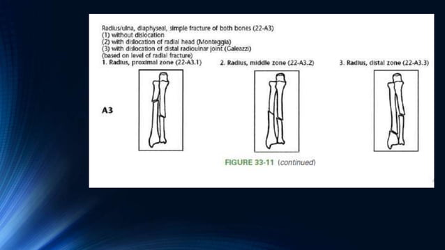 Galleazi fracture dislocation | PPTX | Death, Injury, or Military ...