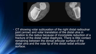 Galleazi fracture dislocation | PPTX
