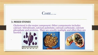 Gallstone presentation | PDF