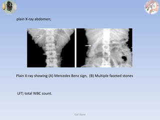 Gallbladder Stones Xray