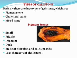GALLSTONE.pptxkkkkkkkkkkkkkkkkkkkkkkkkkkk | PPT