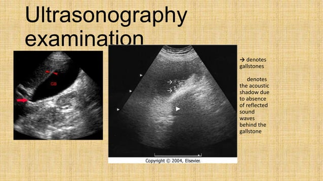 Gall stone disease | PPTX | Digestive Disorders | Diseases and Conditions