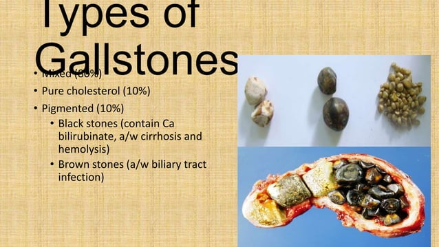 Gall stone disease | PPTX | Digestive Disorders | Diseases and Conditions