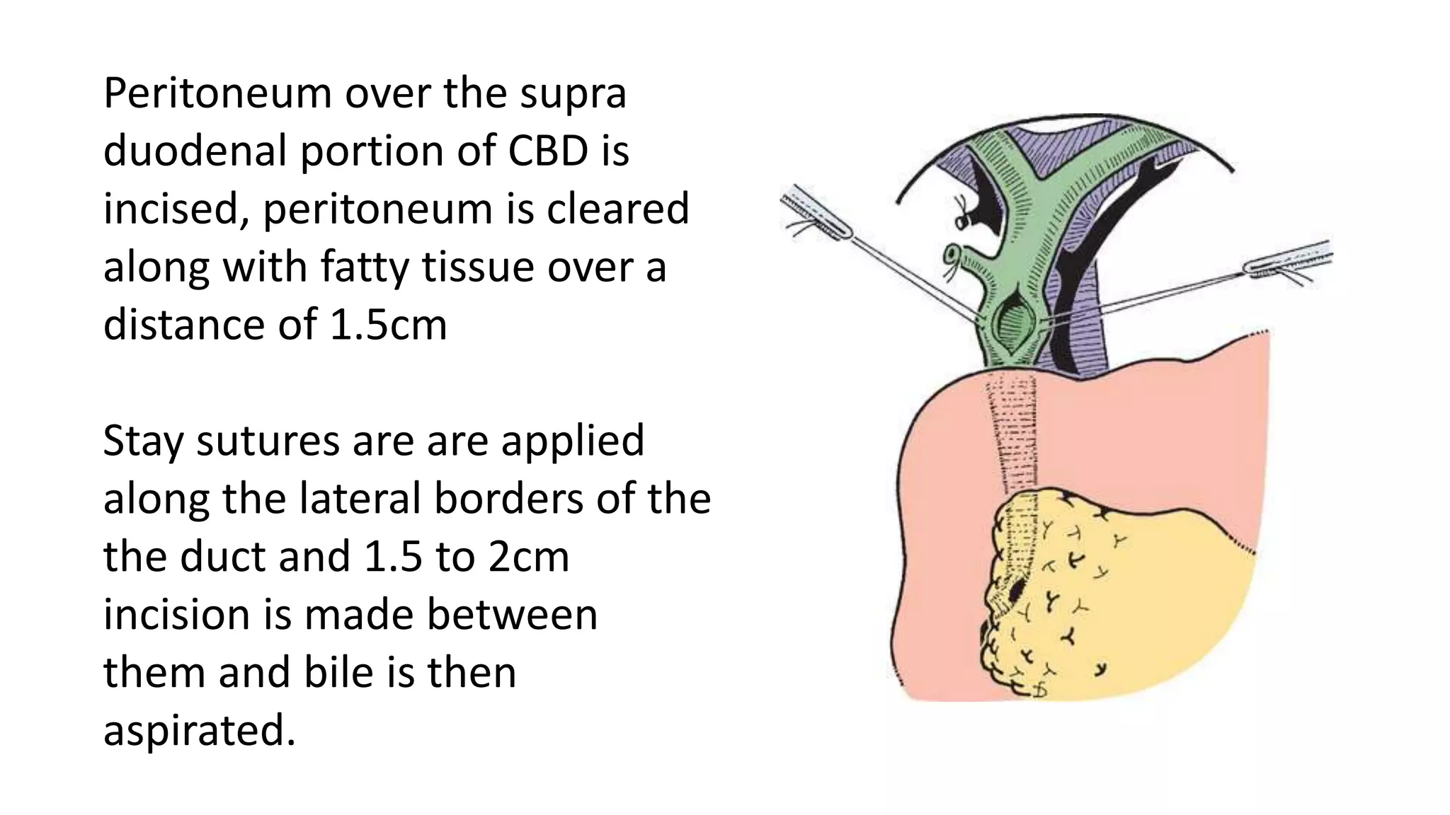 Overview Of Nonsurgical Management Of Gallbladder Stones – DUBSUU