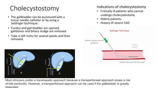 Gall stone management Copy.pptx