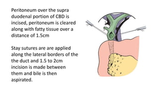 Gall stone management Copy.pptx