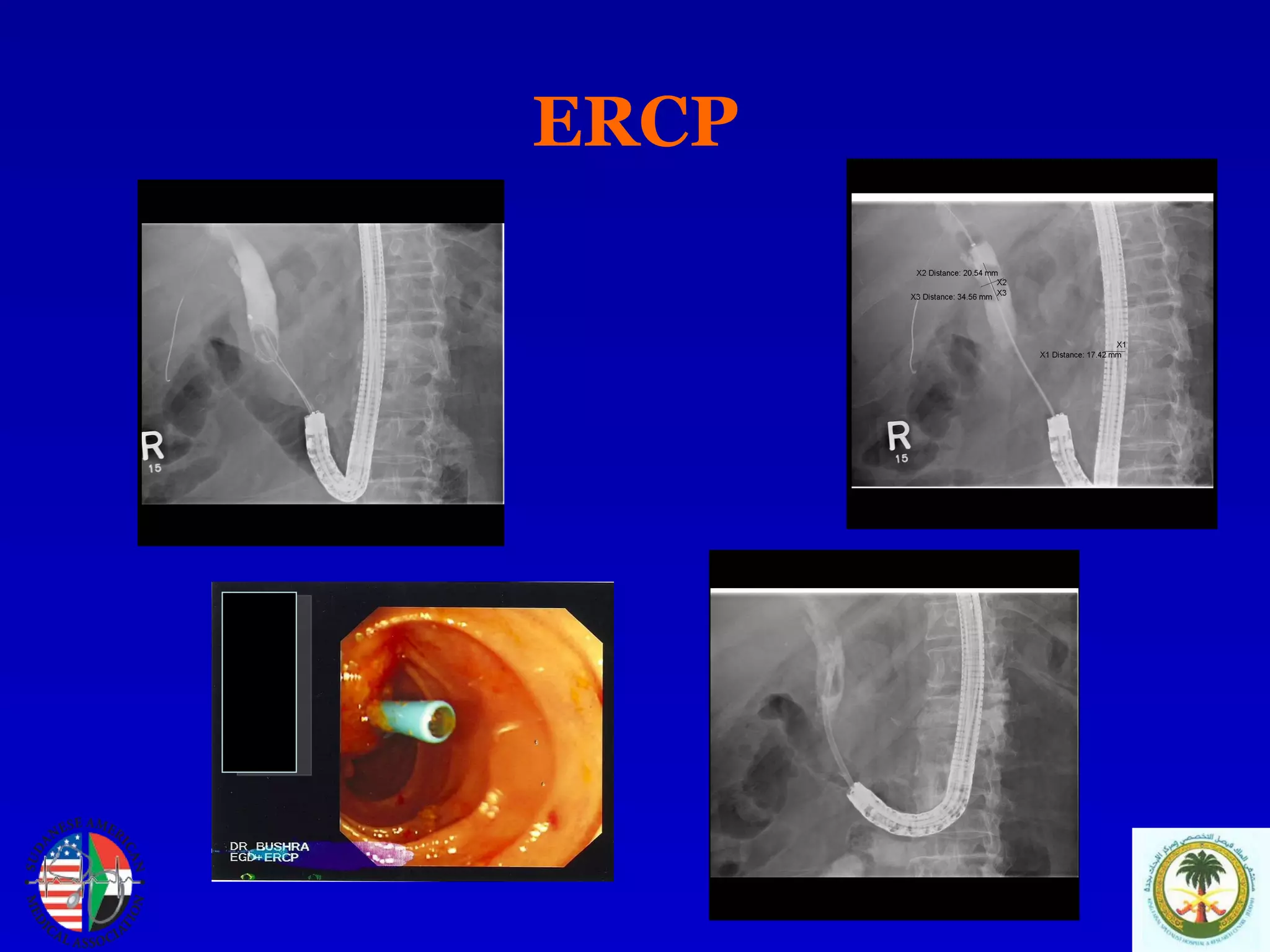 Biliary pancreatitis | PPT