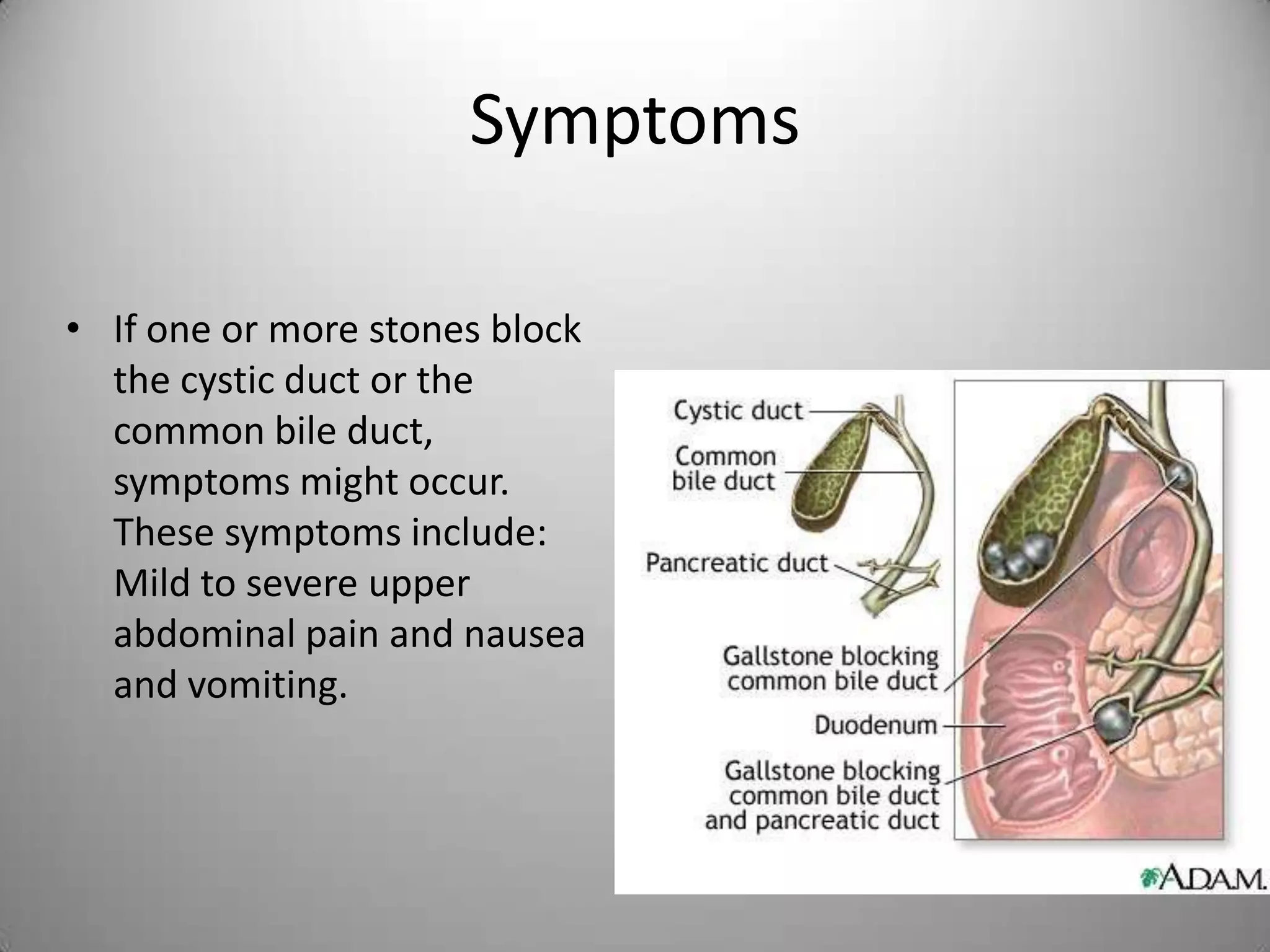 Gallstones | PPTX