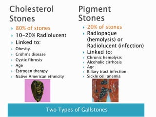 Gallstones | PPT