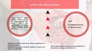 Gallstones | PPTX