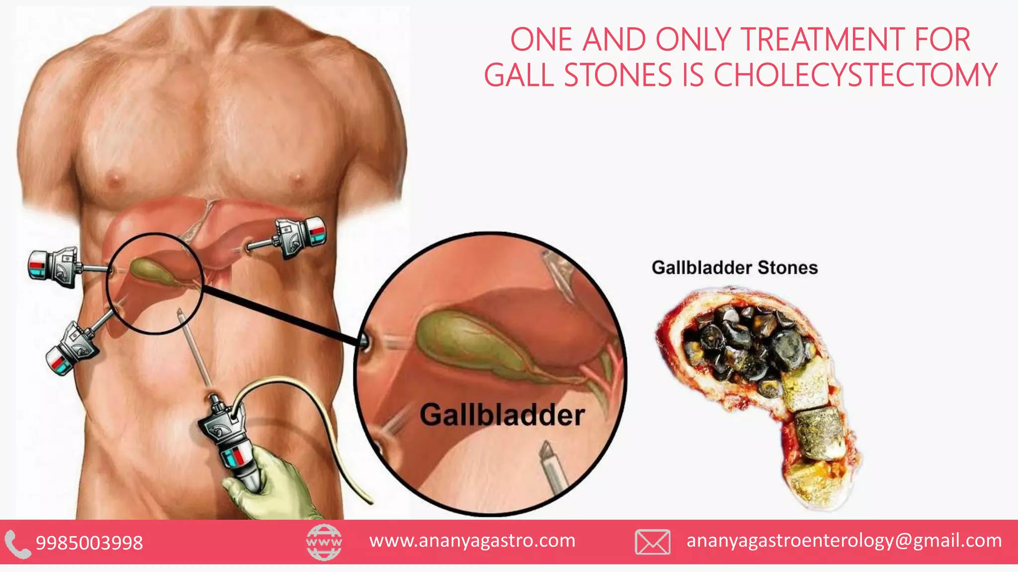 Gallbladder Stone / Gallstones causes, symptoms and treatment by Ananya Gastroenterology | PPTX