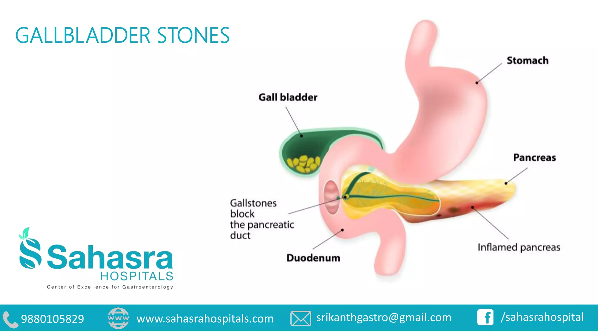 GALLBLADDER STONES SYMPTOMS, CAUSES AND TREATMENT | PPTX