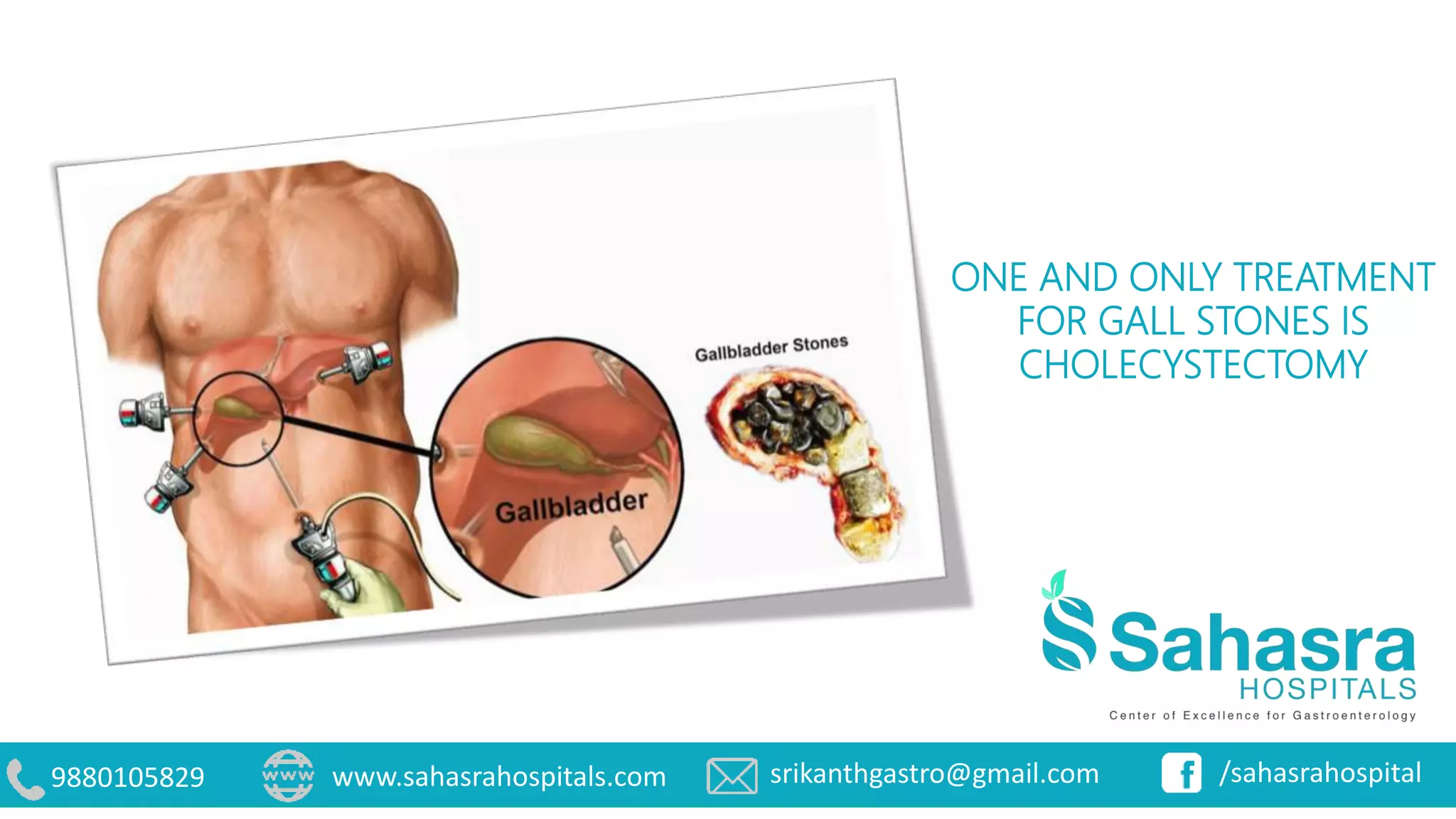 Gallbladder Stone: Symptoms, Causes, Treatments, And Your – MUCMV